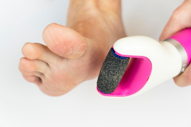 Jak usunąć odcisk z korzeniem? Skuteczne metody i porady - Portal Medica